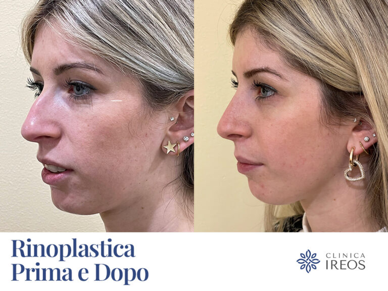 Rinoplastica Prima Dopo - Galleria Interventi Ireos